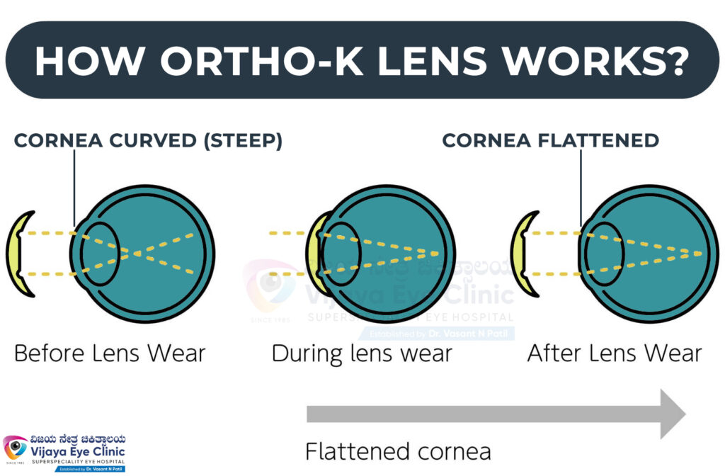 Get Rid Of Glasses Without Surgery In Bangalore: Discover Freedom With Ortho-K Lenses At Vijaya ...